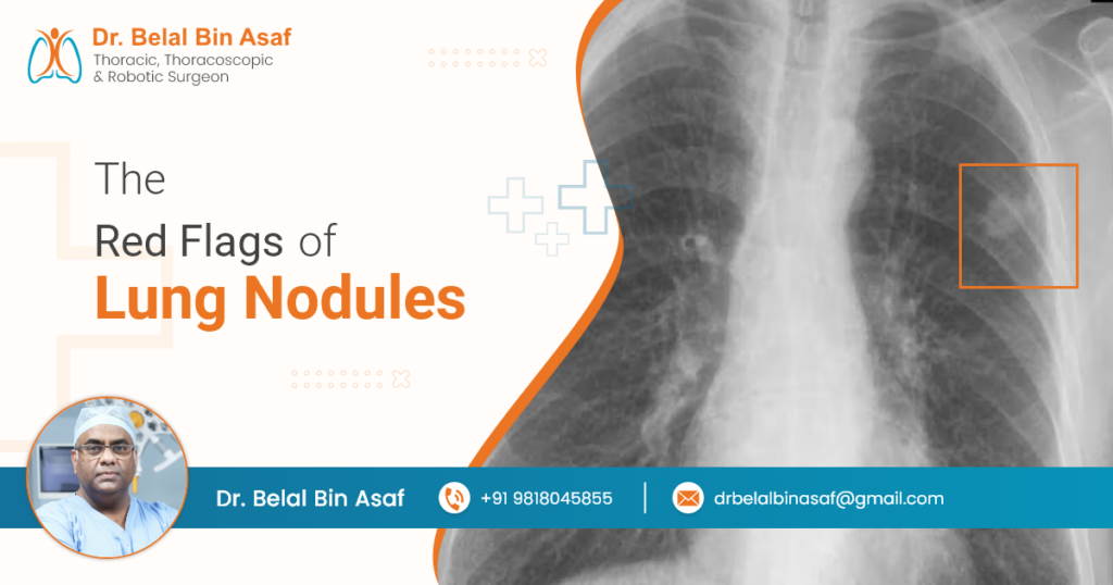 What are the Red Flags of Lung Nodules