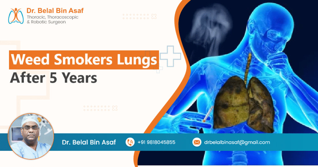 Weed Smokers Lungs After 5 Years - Dr Belal Bin Asaf
